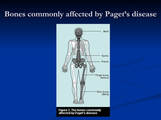 Paget’S Disease Of Bone | PPT
