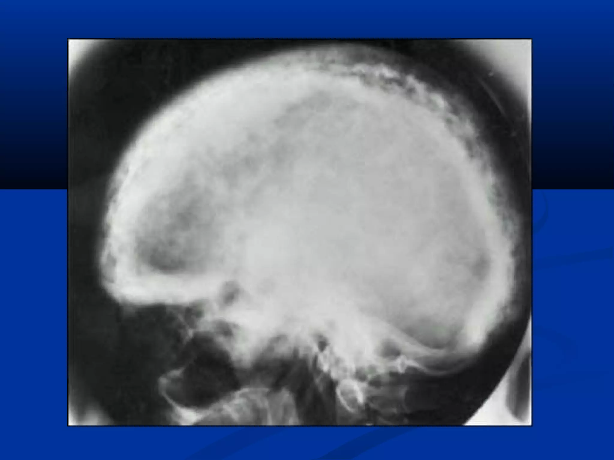 Pagets disease-of-bone-by dr.athar | PPT