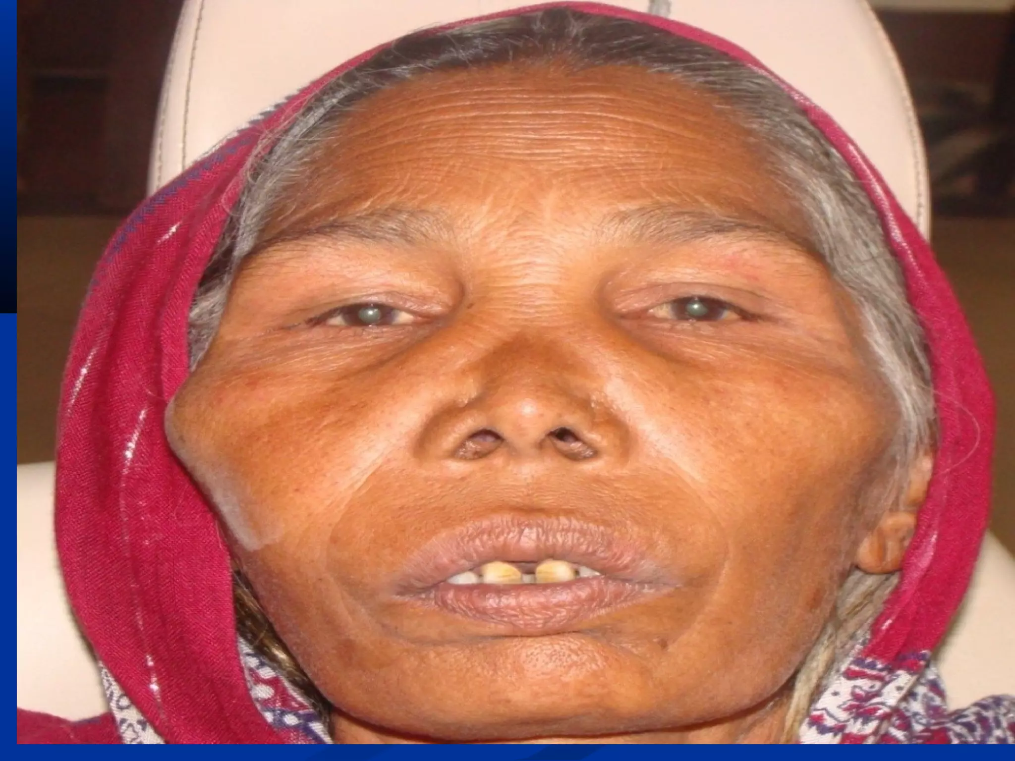 Pagets disease-of-bone-by dr.athar | PPT