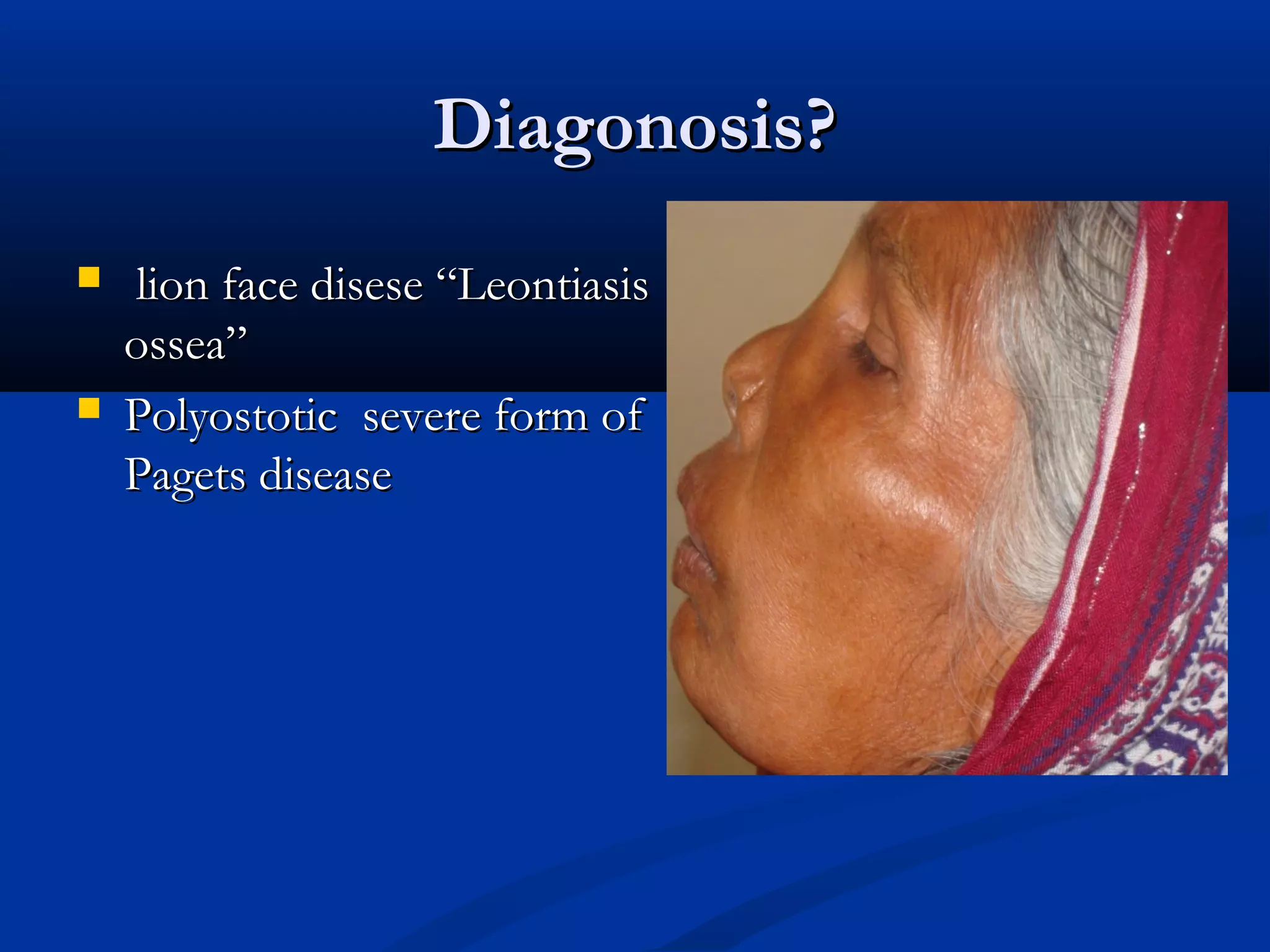 Pagets disease-of-bone-by dr.athar | PPT