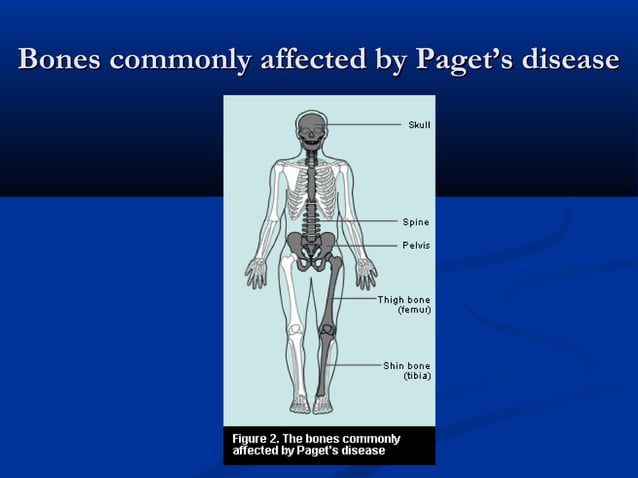 Pagets disease-of-bone-by dr.athar | PPT