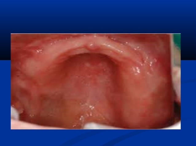 Pagets disease-of-bone-by dr.athar | PPT