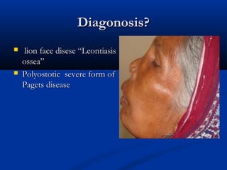 Pagets disease-of-bone-by dr.athar | PPT