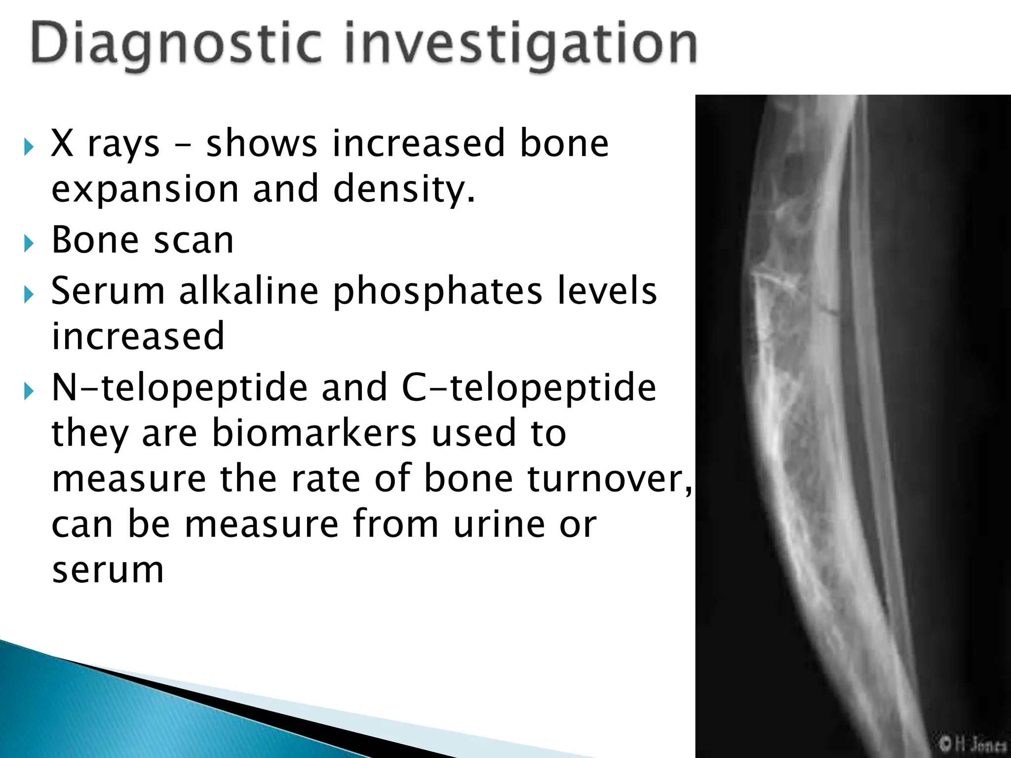 pagets-disease-osteitis-deformans p.pptx