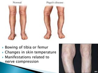 pagets-disease-osteitis-deformans p.pptx