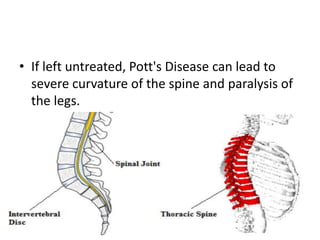 Pagets and potts | PPT