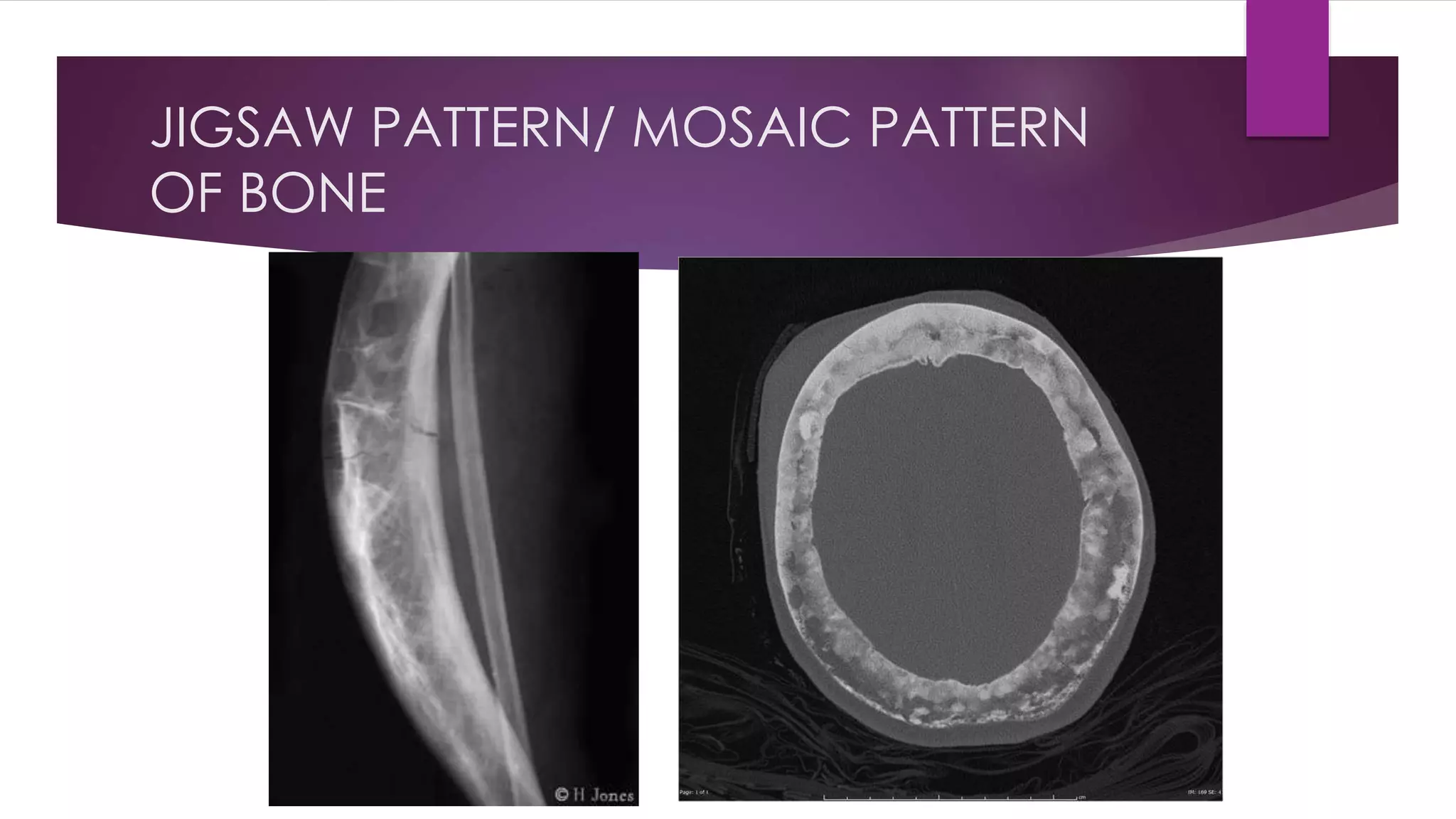 Signs in Paget’s disease | PPTX