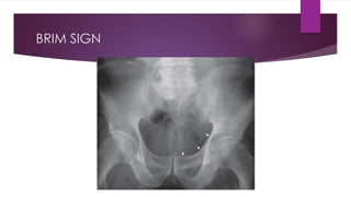 Signs in Paget’s disease | PPTX