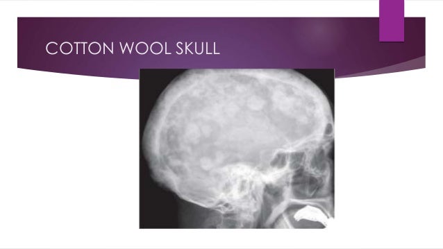 Signs in Paget’s disease