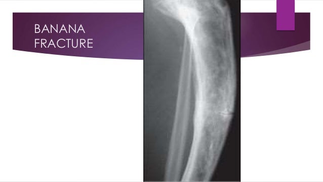Signs in Paget’s disease