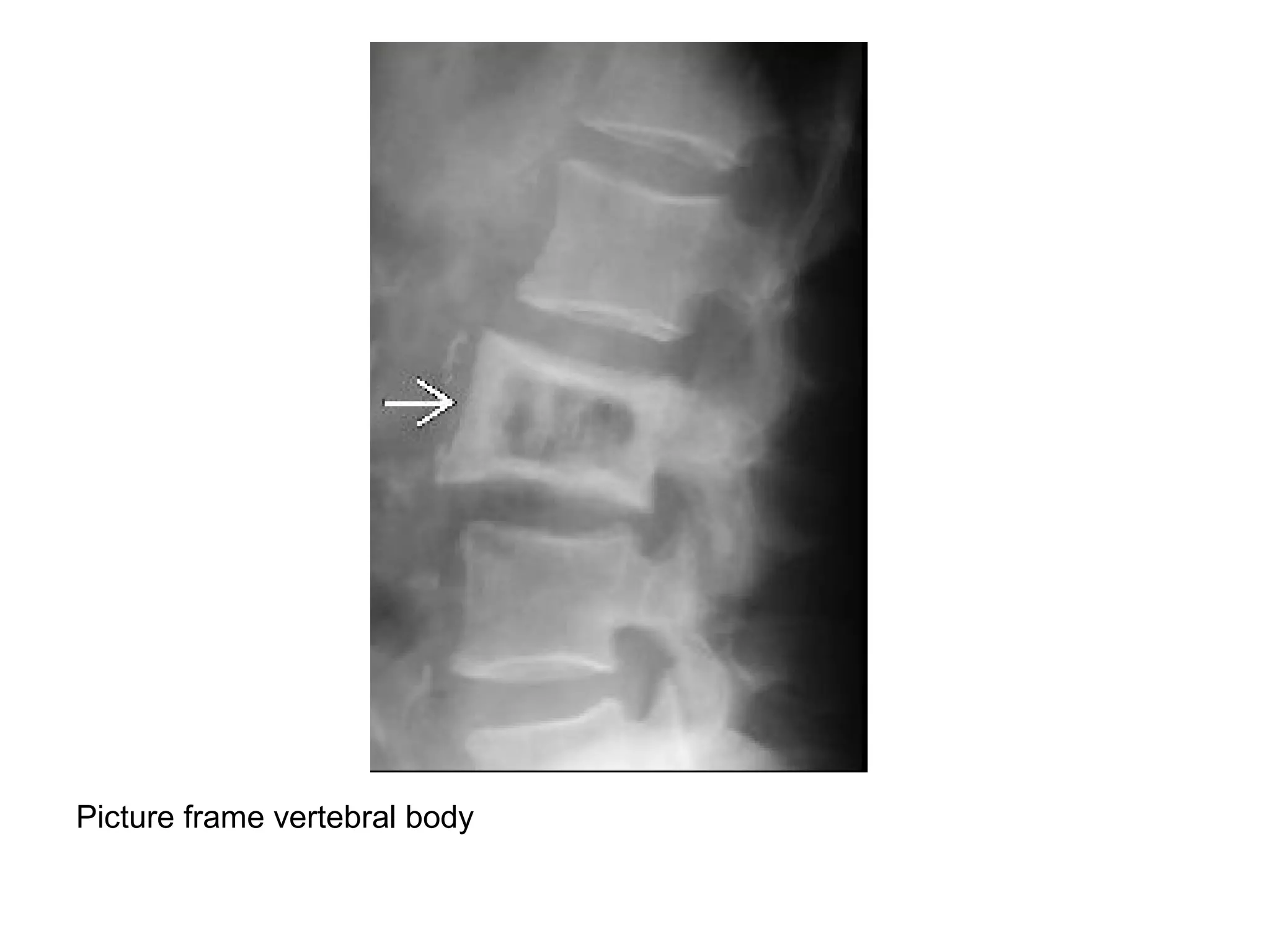 Diagnostic Imaging of Paget's Disease | PPT