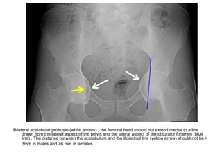 Diagnostic Imaging of Paget's Disease | PPT