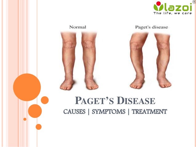 Paget’s disease : causes, symptoms, diagnosis and treatment