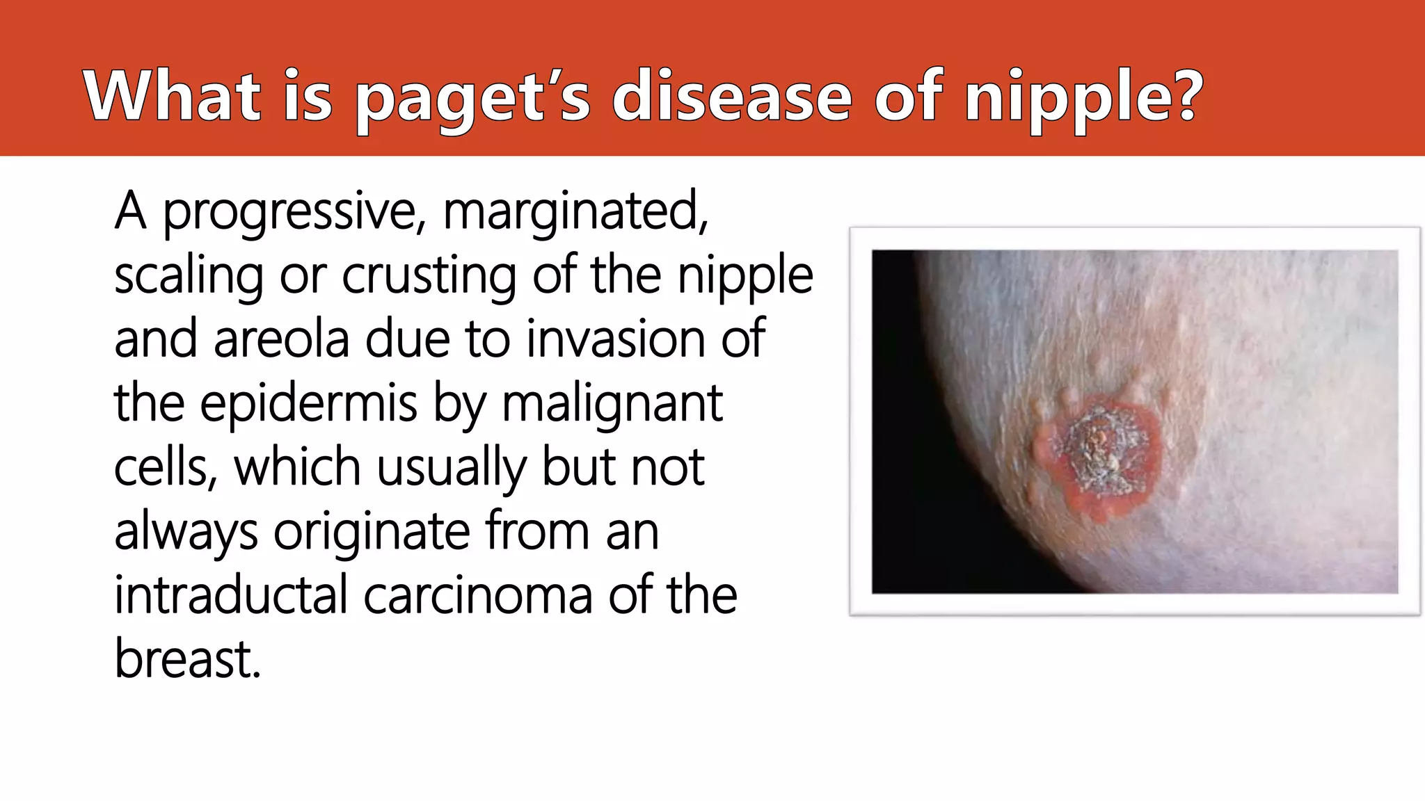 Paget's disease | PPTX