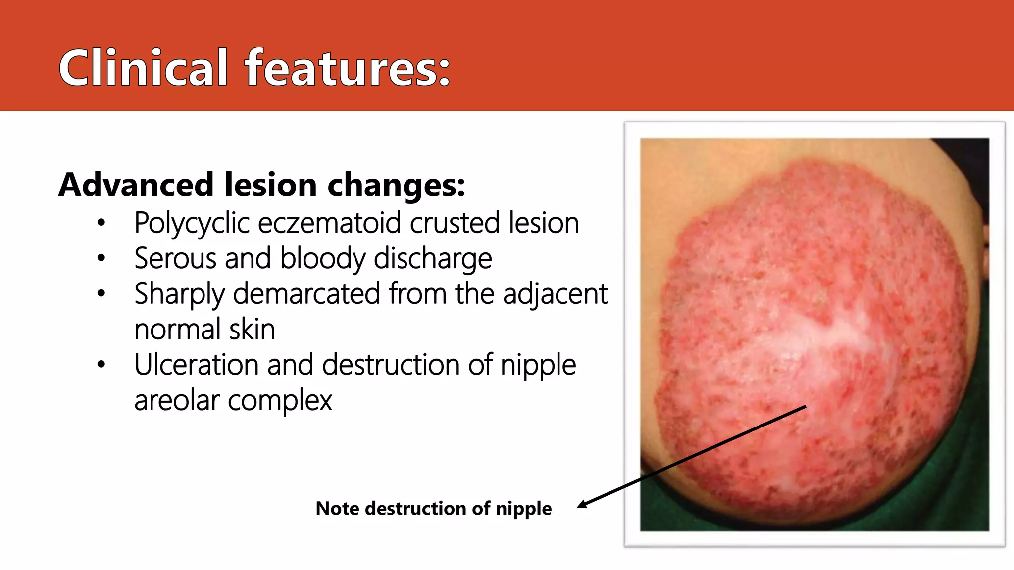Paget's disease | PPTX