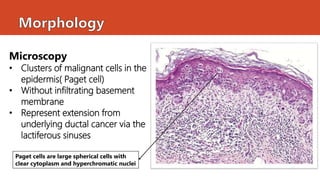 Paget's disease | PPTX