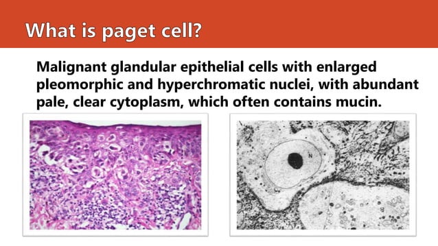 Paget's disease | PPTX | Skin and Dermatology | Diseases and Conditions