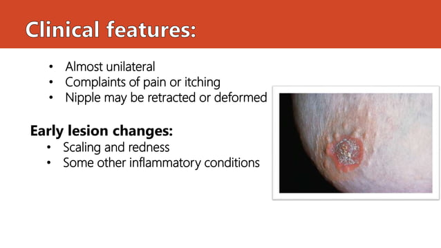 Paget's disease | PPTX | Skin and Dermatology | Diseases and Conditions
