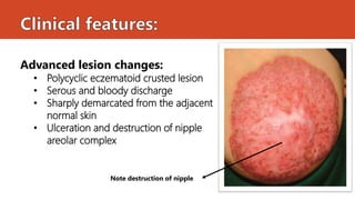 Paget's disease | PPTX