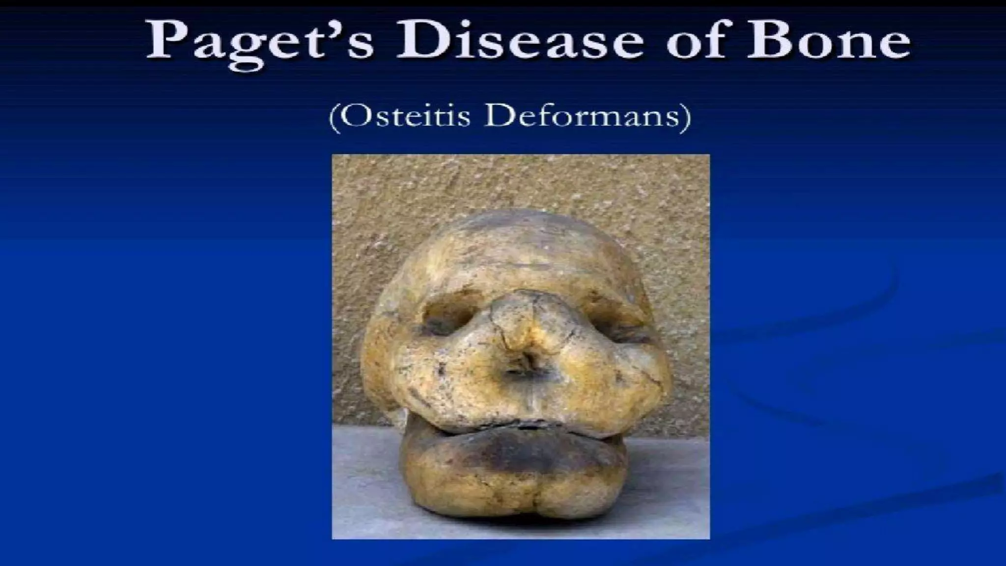 Paget's disease Musculo Skeletal Disorders For Nursing Student Under ...