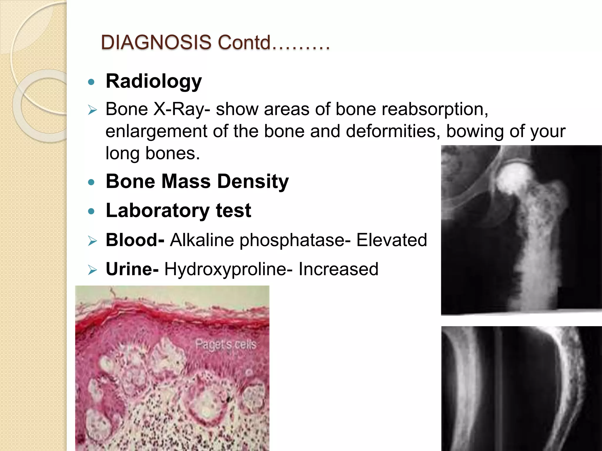 PAGET'S DISEASE | PPTX