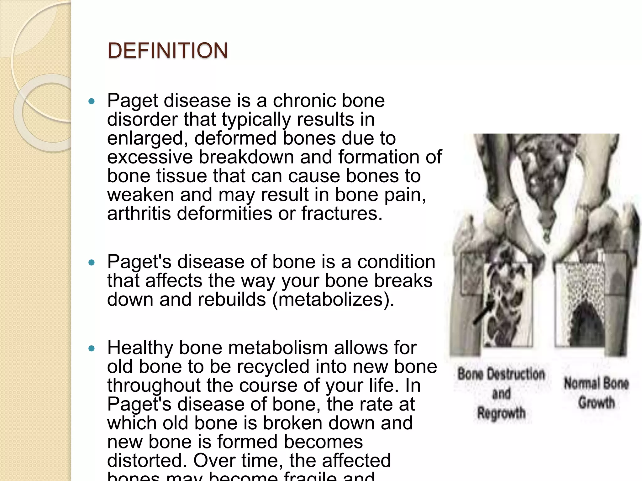 PAGET'S DISEASE | PPTX