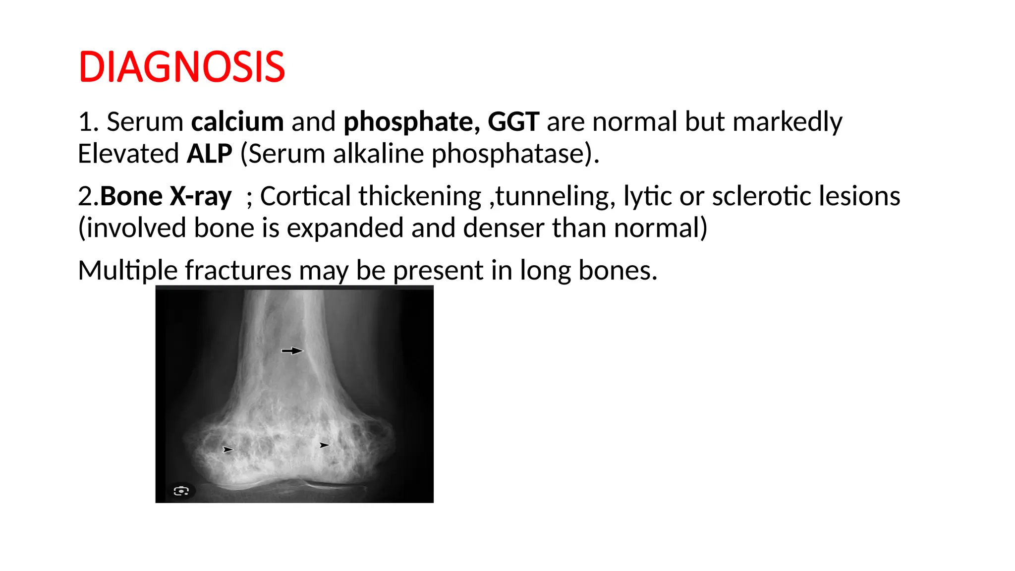 Paget’s disease and other dysplasia of bone..pptx
