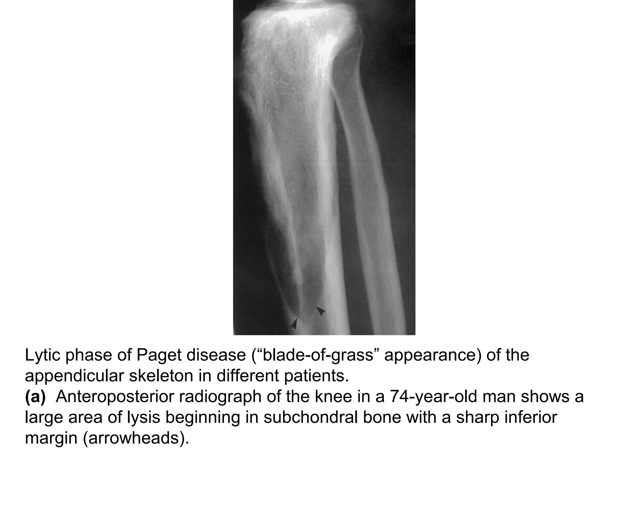 Pagets disease of bone | PPT