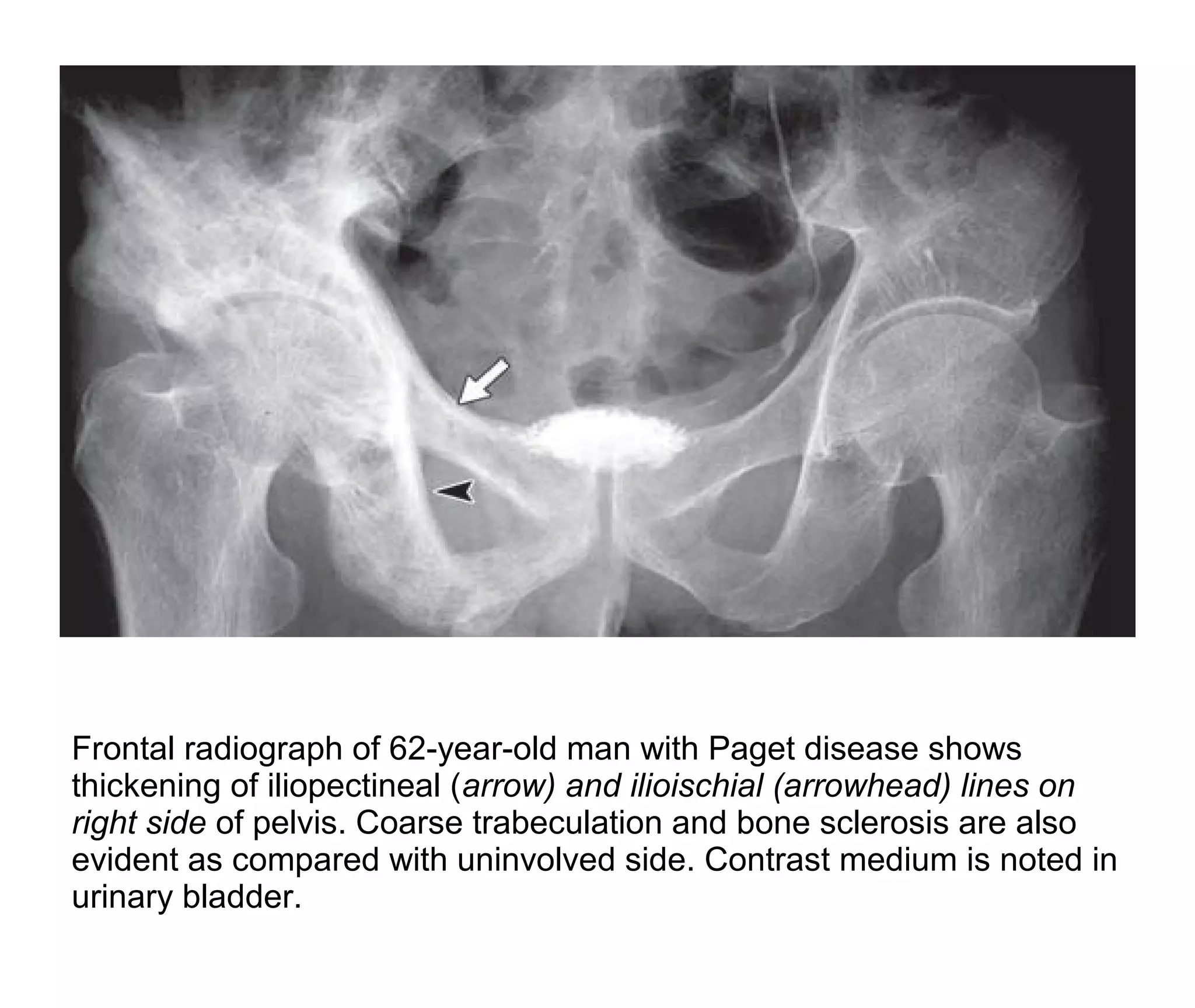Pagets disease of bone | PPT