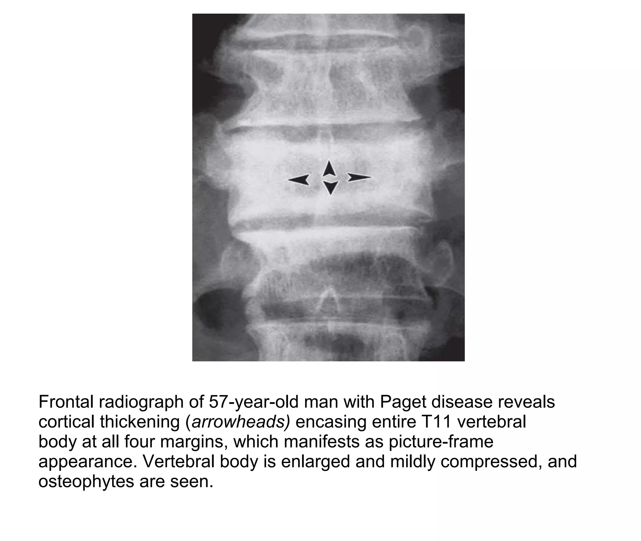 Pagets disease of bone | PPT