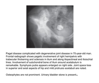 Pagets disease of bone | PPT