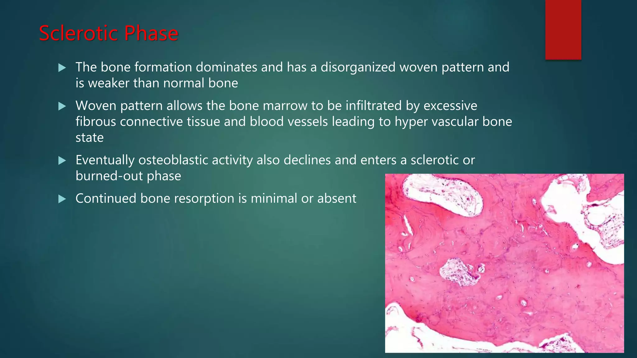 Pagetsdiseaseofthebone | PDF