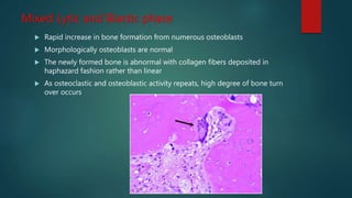 Pagetsdiseaseofthebone | PDF