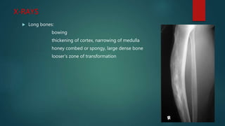 Paget’s disease of the bone | PPTX