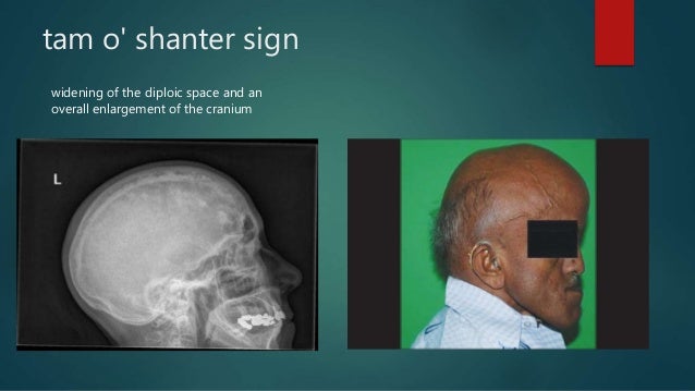 Paget’s disease of the bone