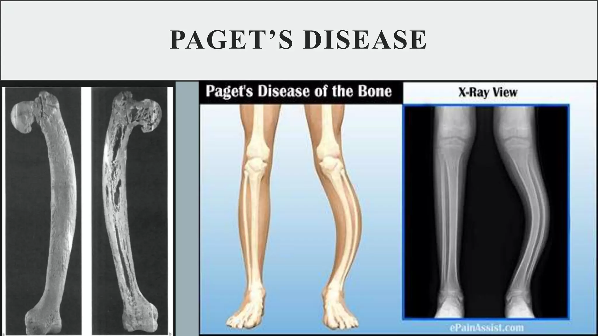 PAGET’S DISEASE ppt.pptx