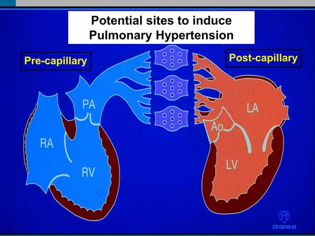 Pulmonary artery hypertension | PPT | Heart and Cardiovascular Diseases ...