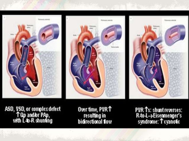 Pulmonary arterial hypertension (PAH) in ccongenital heart diseases | PPT