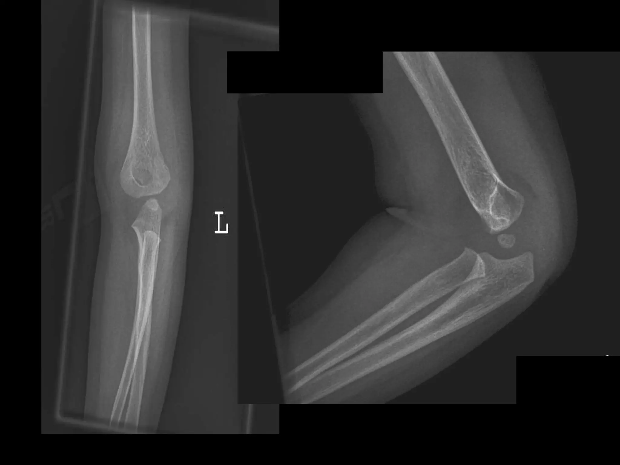 Radiology Rounds: Pain After Fall | PPT