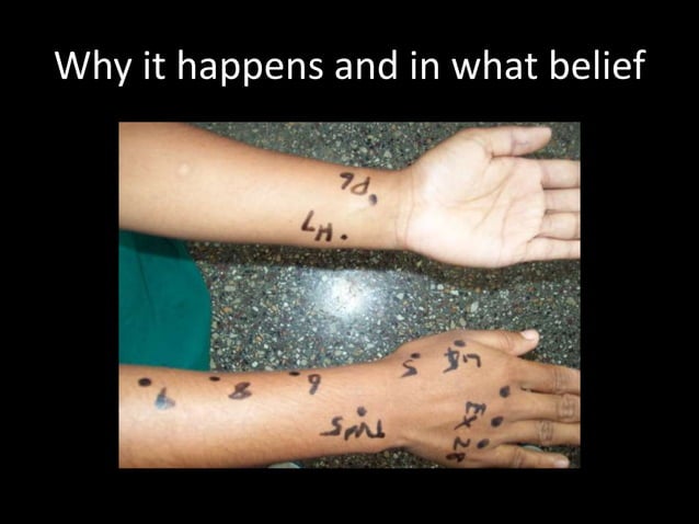 Pain complex regional pain syndrome | PPT