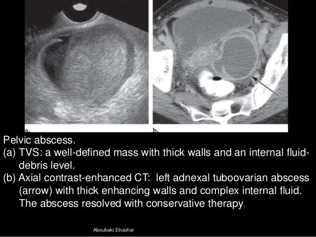 Ultrasound Postparttum Pelvic Abscess Rt With Extension