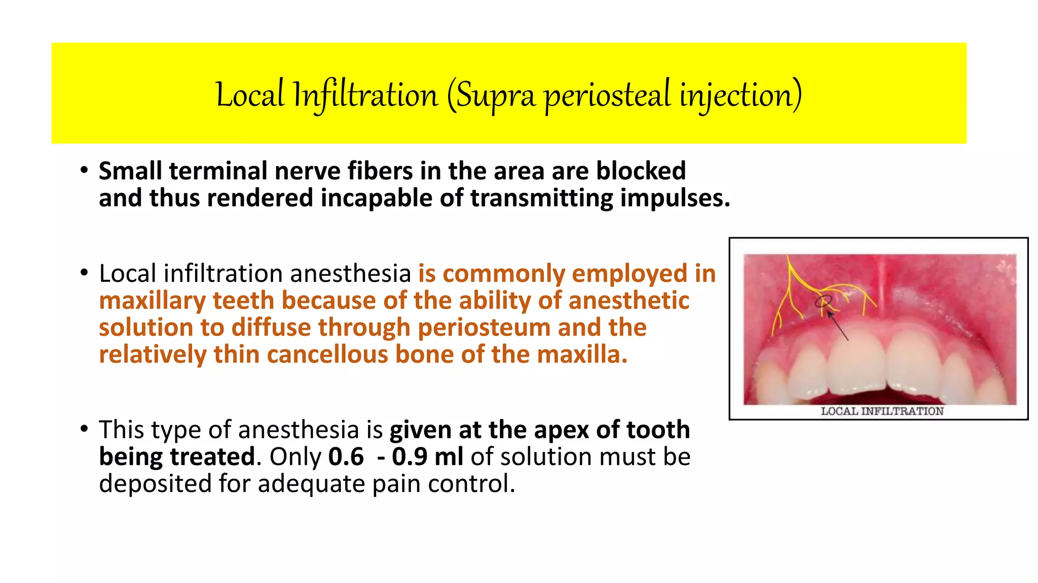 Pain control in endodontics | PPTX