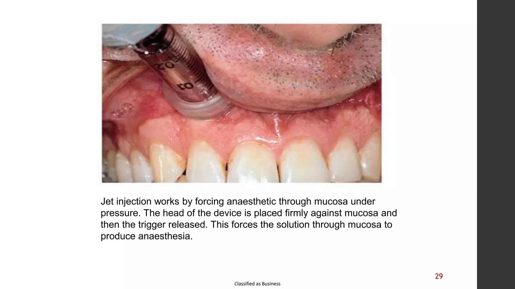 PAIN CONTROL IN OPERATIVE DENTISTRY AND ENDODONTICS.pptx