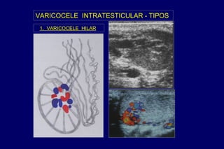 Painel digital varicocele - Aula do Dr Décio Prando - | PPT