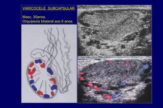 Painel digital varicocele - Aula do Dr Décio Prando - | PPT