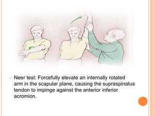 Painful arch syndrome | PPTX