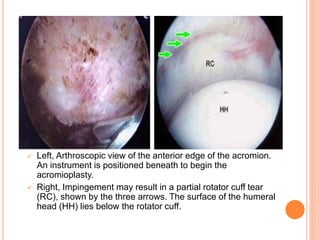 Painful arch syndrome | PPTX