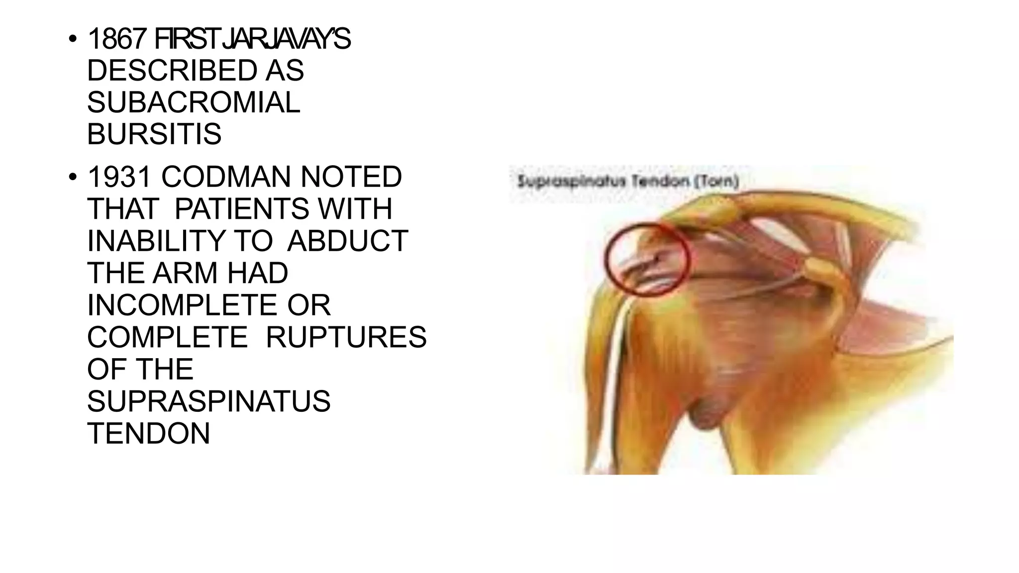 Painful arc syndrome | PPTX