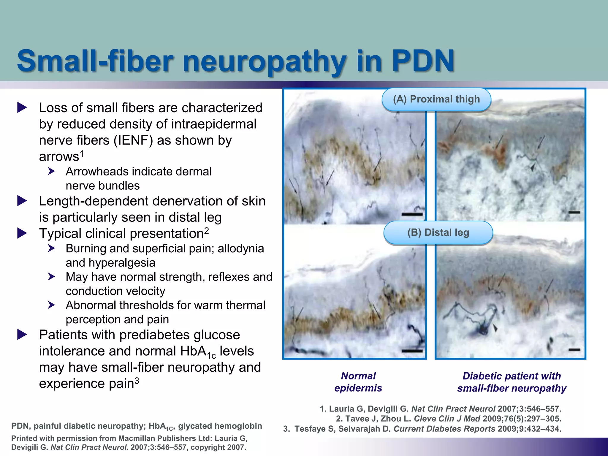 Painful diabetic peripheral neuropathy: diagnosis and management | PPTX