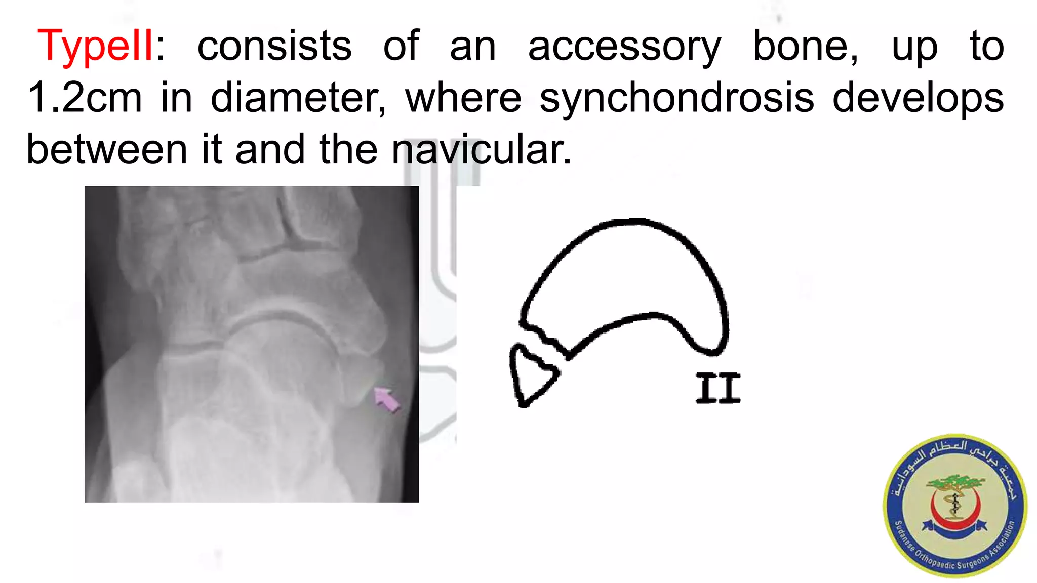 painfull accessory navicular bone(1).pptx